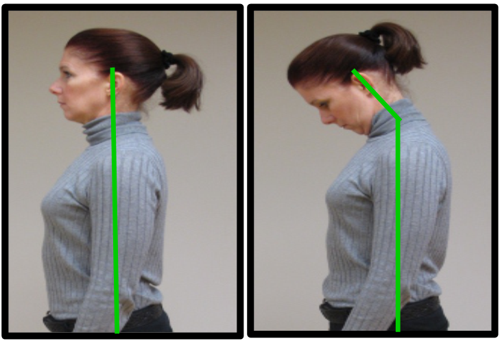 Over Flexed Posture Standing